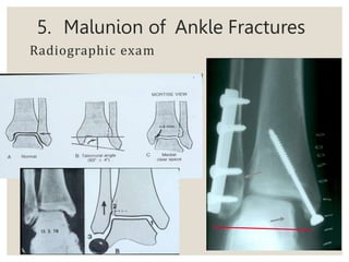 non union and malunion final.pptx