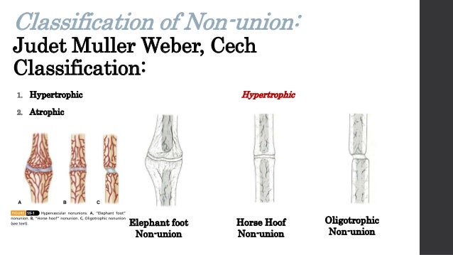 Non union by rv ppt