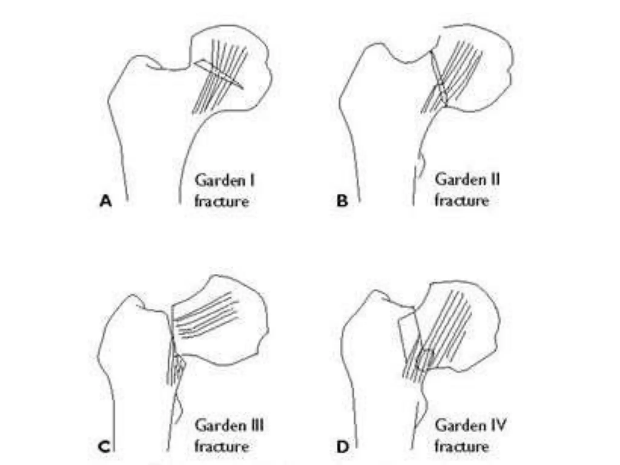 Nonunion femoral neck fractures | PPTX