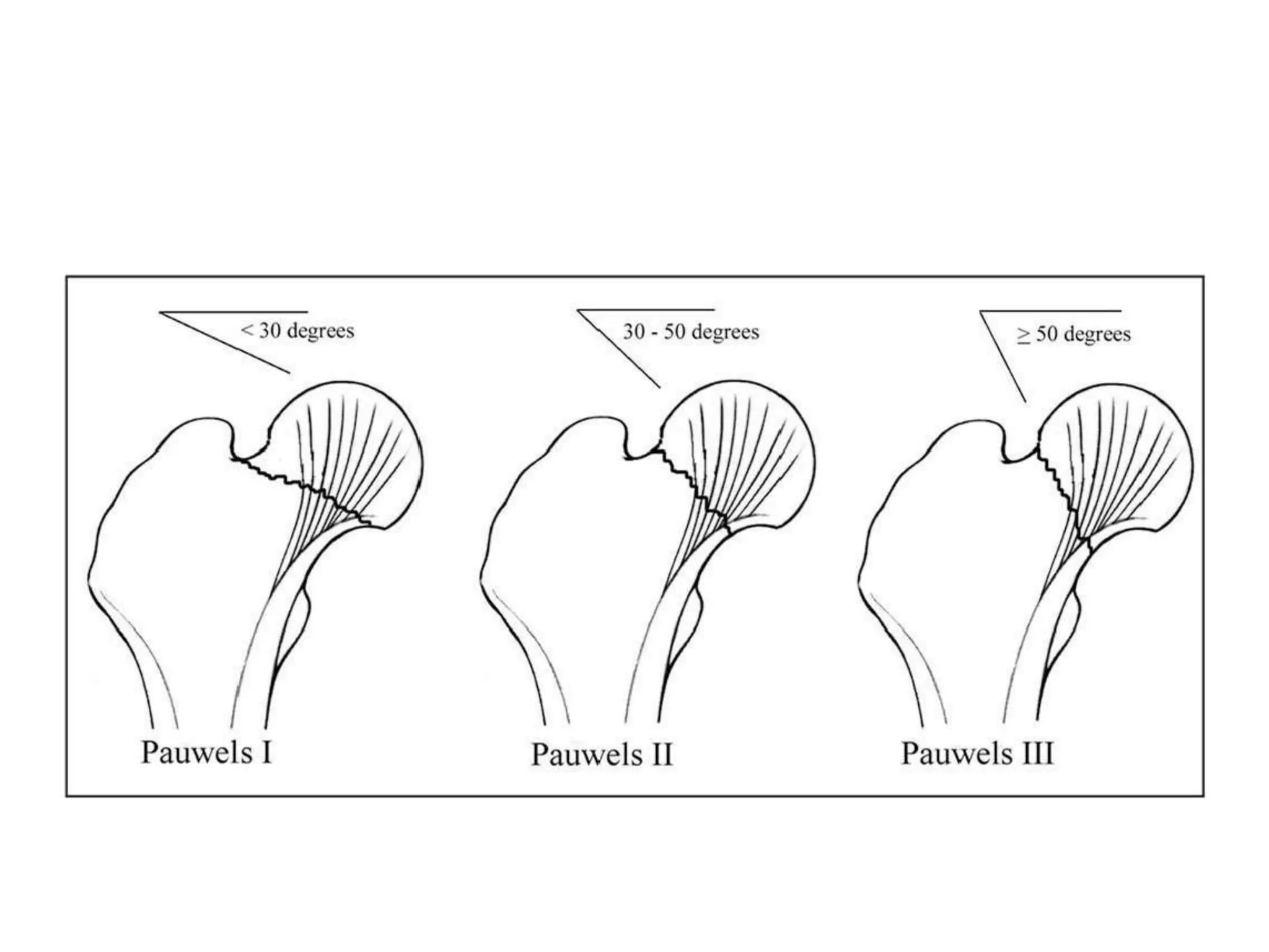 Nonunion femoral neck fractures | PPTX