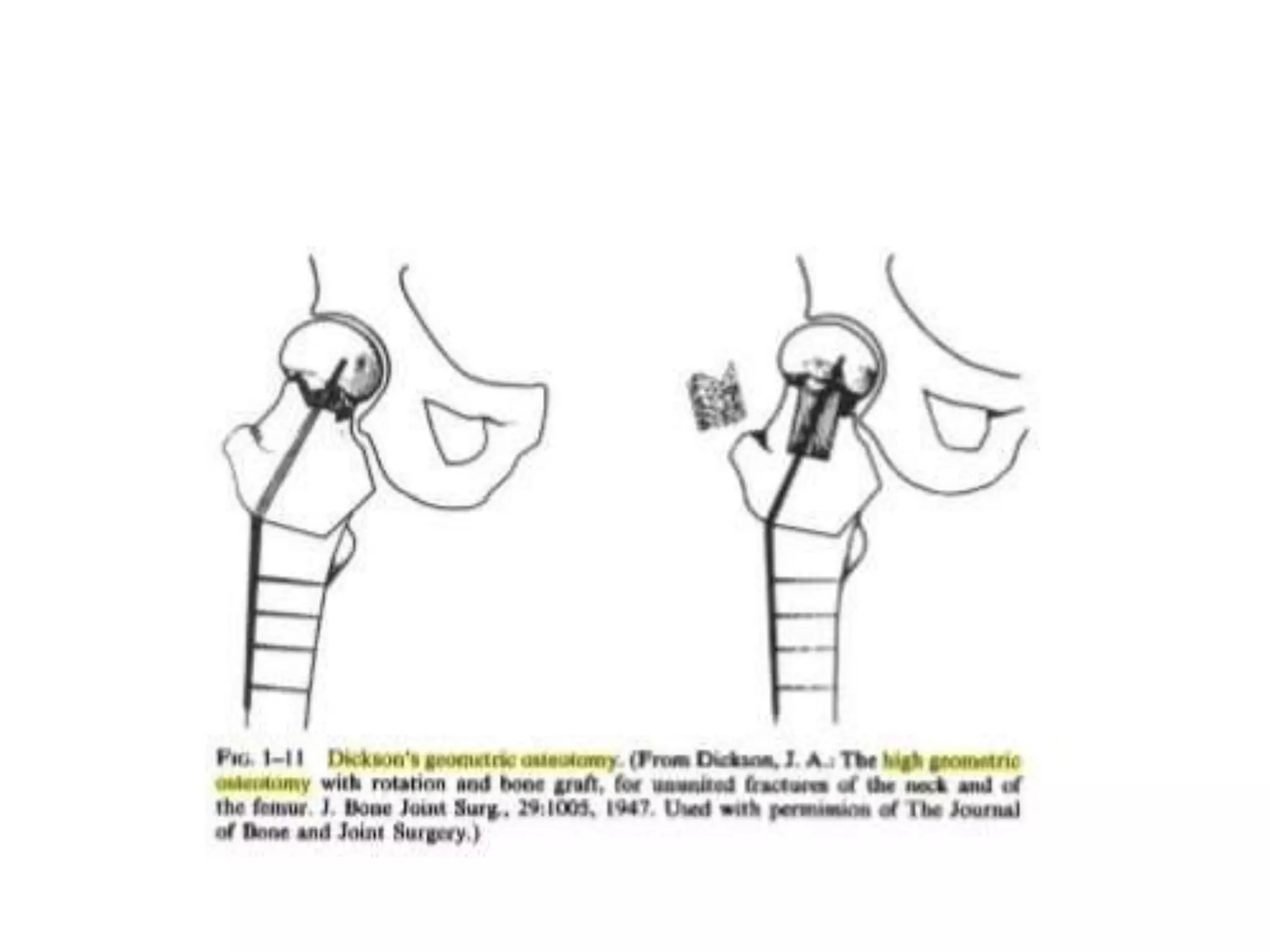 Nonunion femoral neck fractures | PPTX
