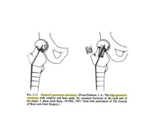 Nonunion femoral neck fractures | PPTX | Death, Injury, or Military ...