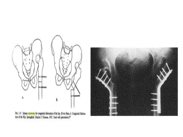 Nonunion femoral neck fractures | PPTX | Death, Injury, or Military ...