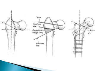 Non union fracture neck of femur | PPT
