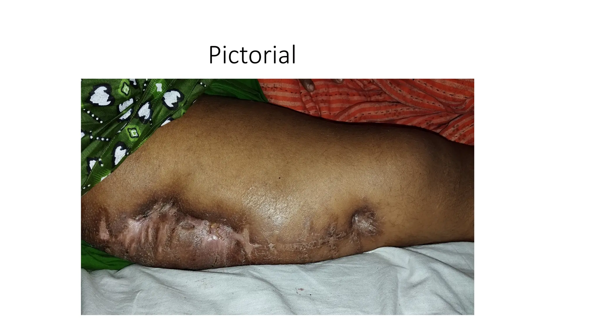 non union fracture sof-1dhdbdhdbgdb.pptx