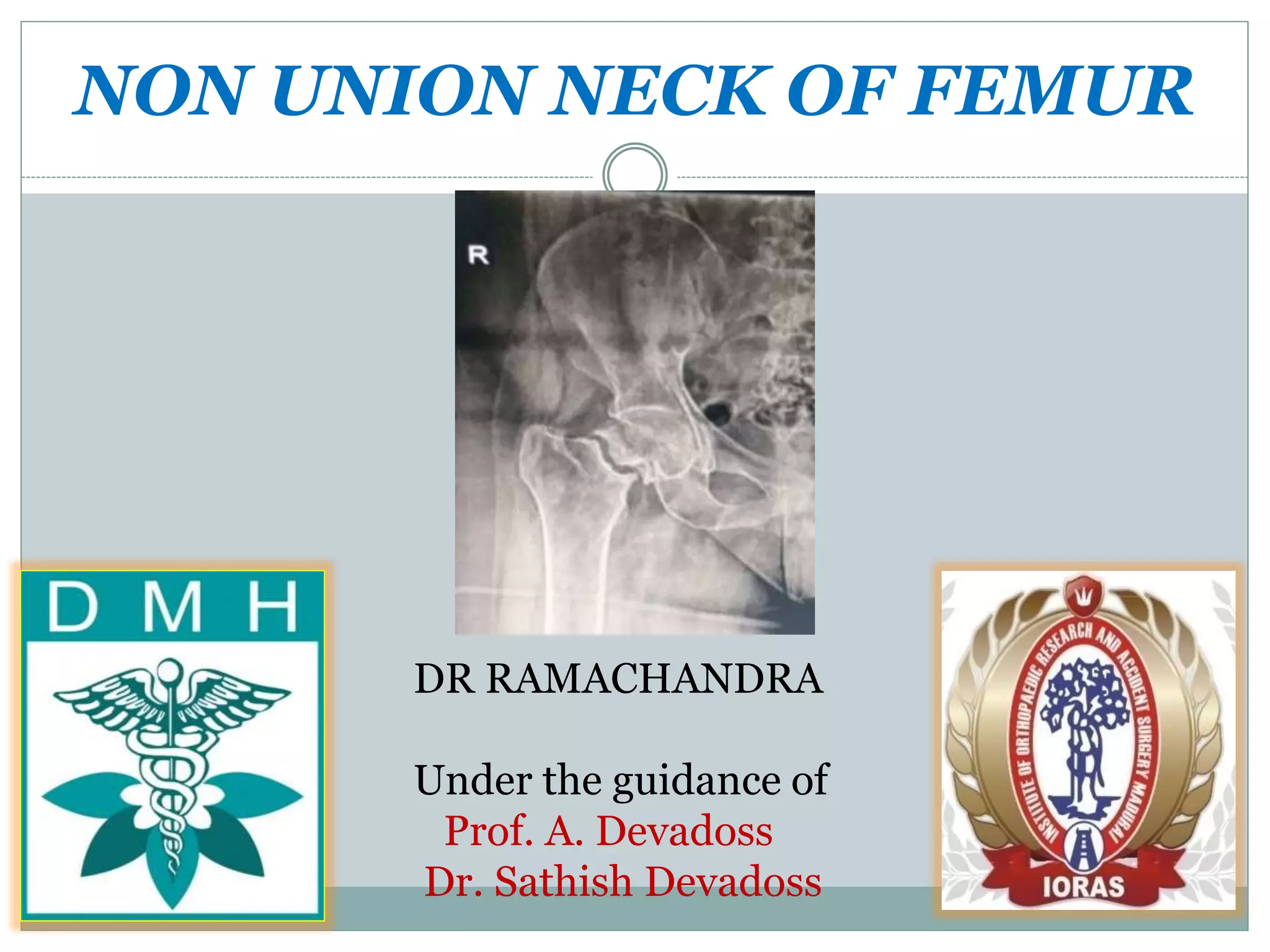 Non union neck of femur | PPTX