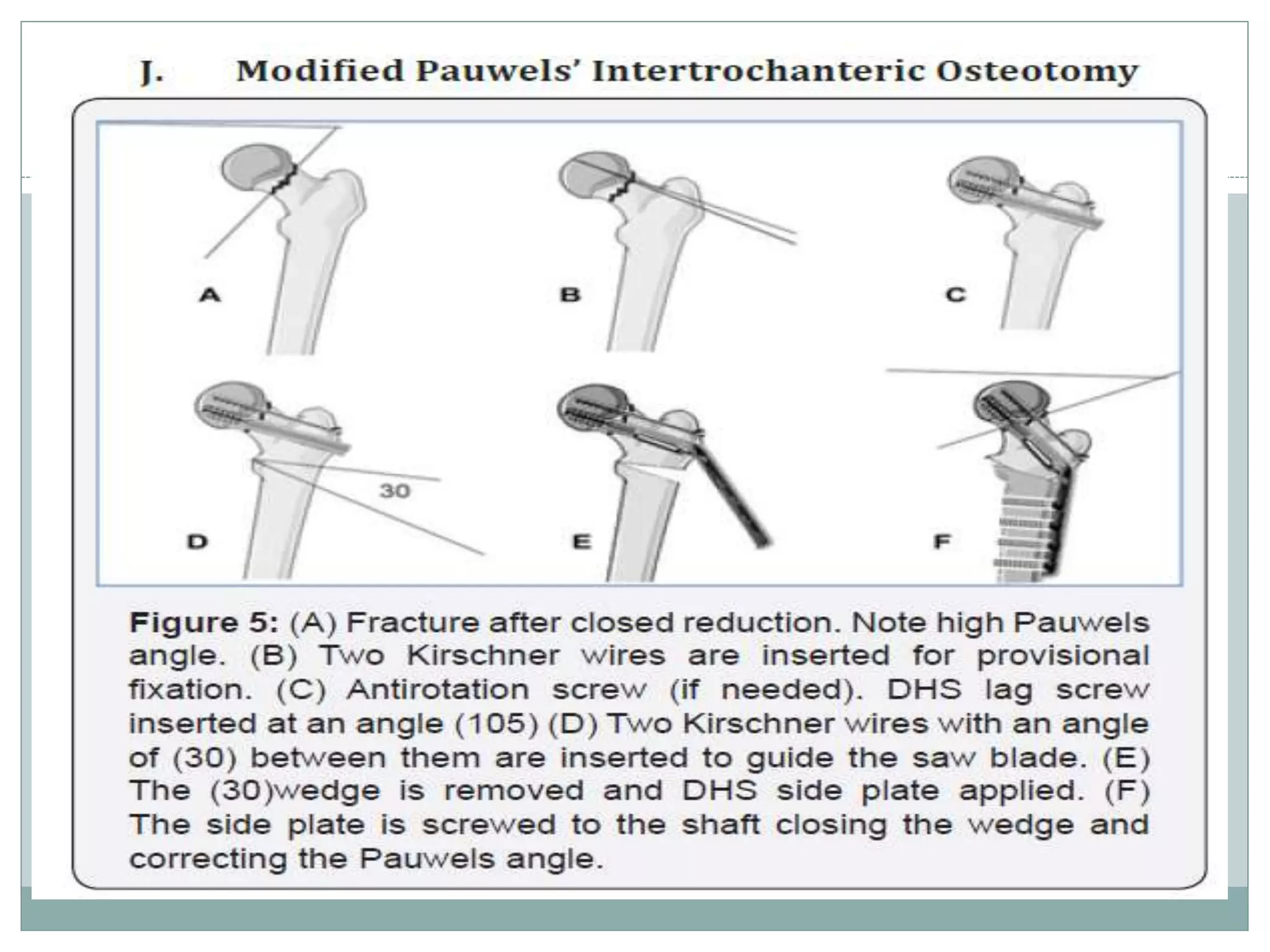 Non union neck of femur | PPTX