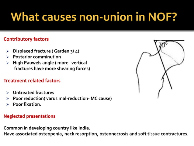 Non union neck of femur | PPTX | Death, Injury, or Military Conflict ...