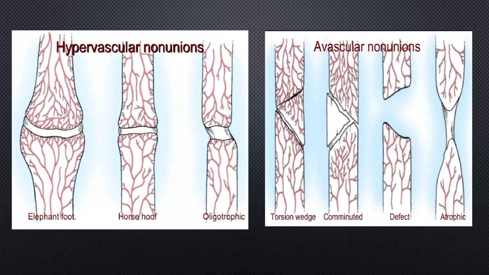 non union of bones.pptx