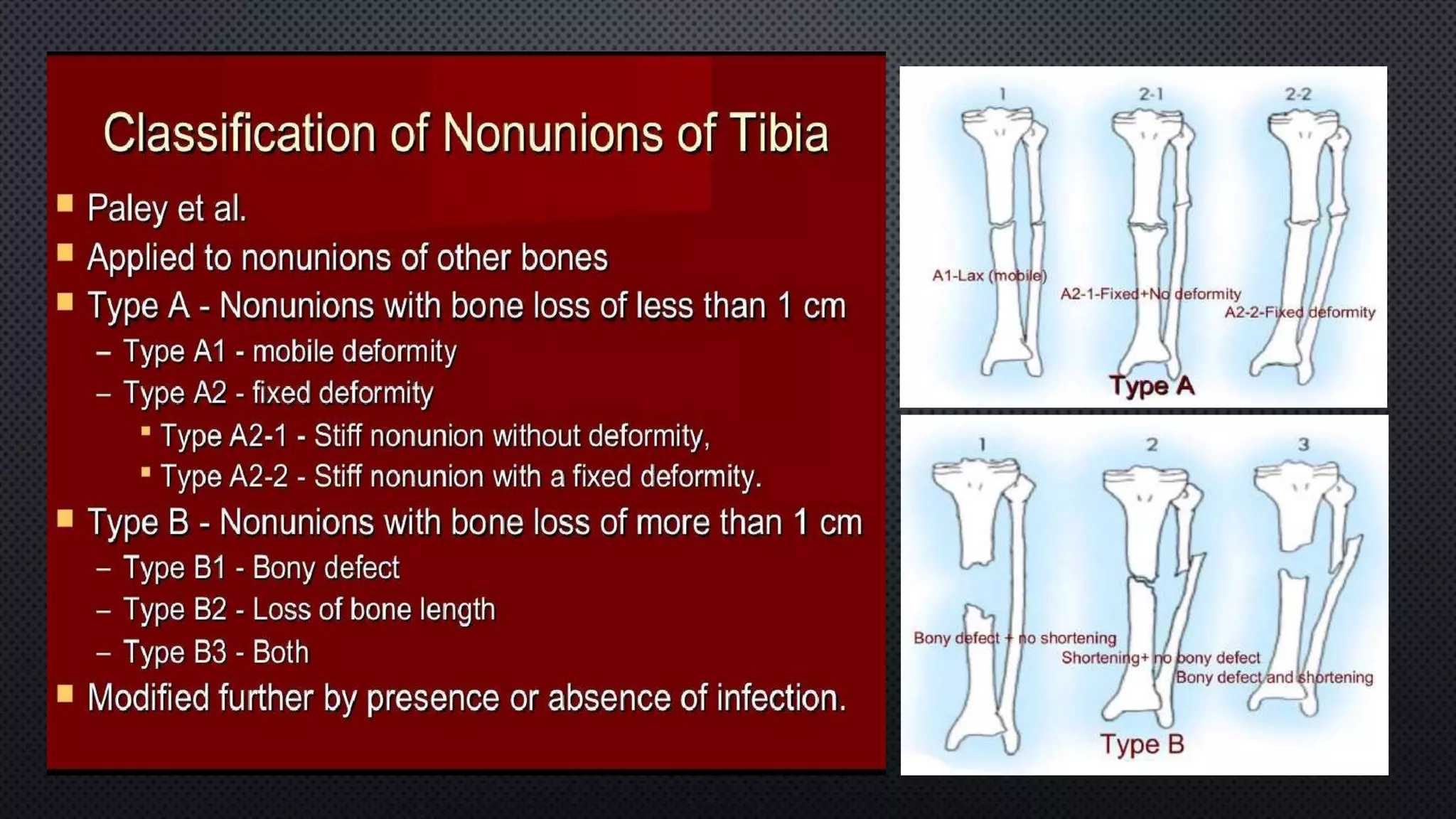 non union of bones.pptx