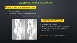 non union of bones.pptx