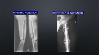 non union of bones.pptx