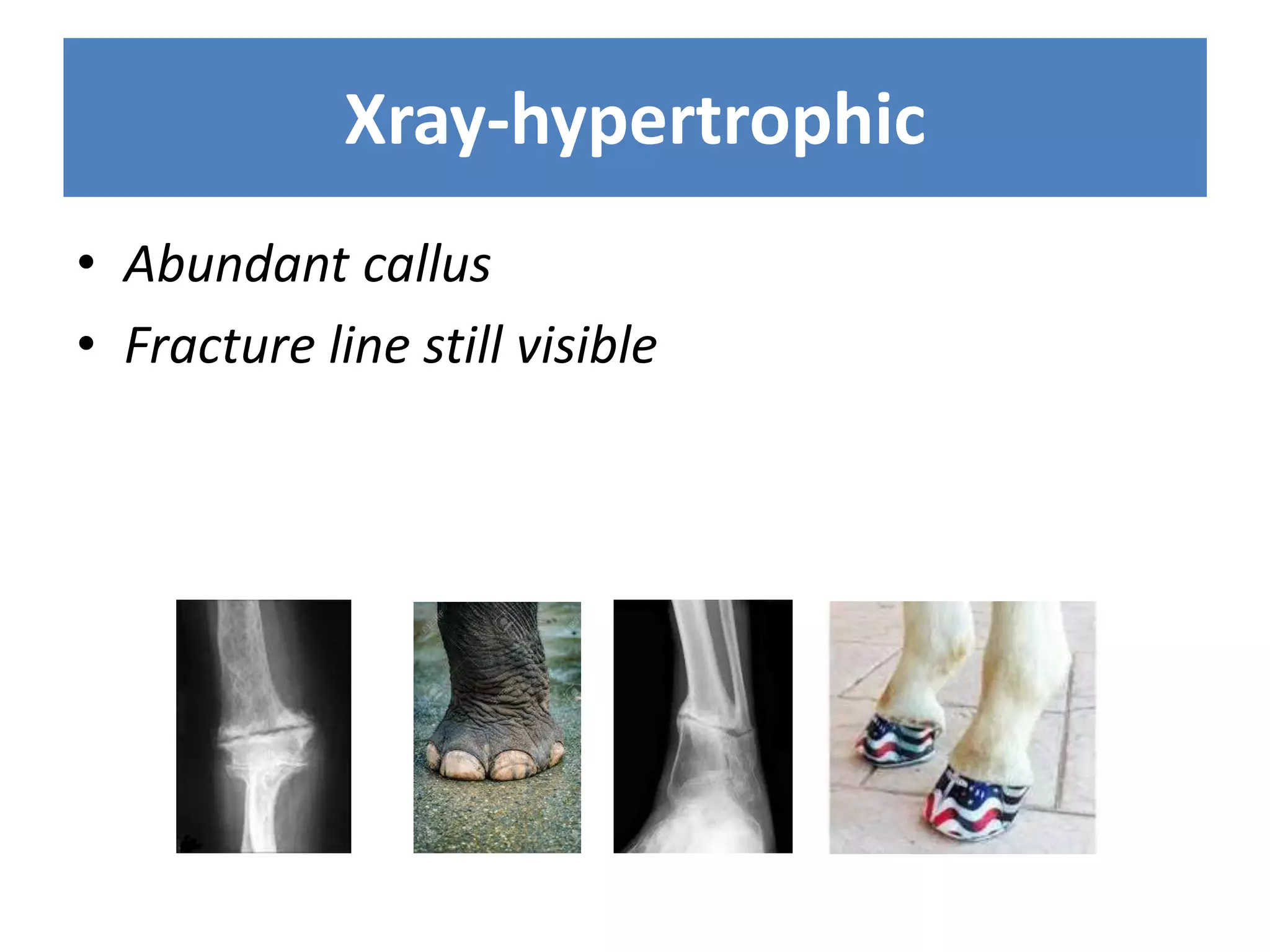 Non union of fractures dr mohamed ashraf,HOD orthopaedics,govt TD ...