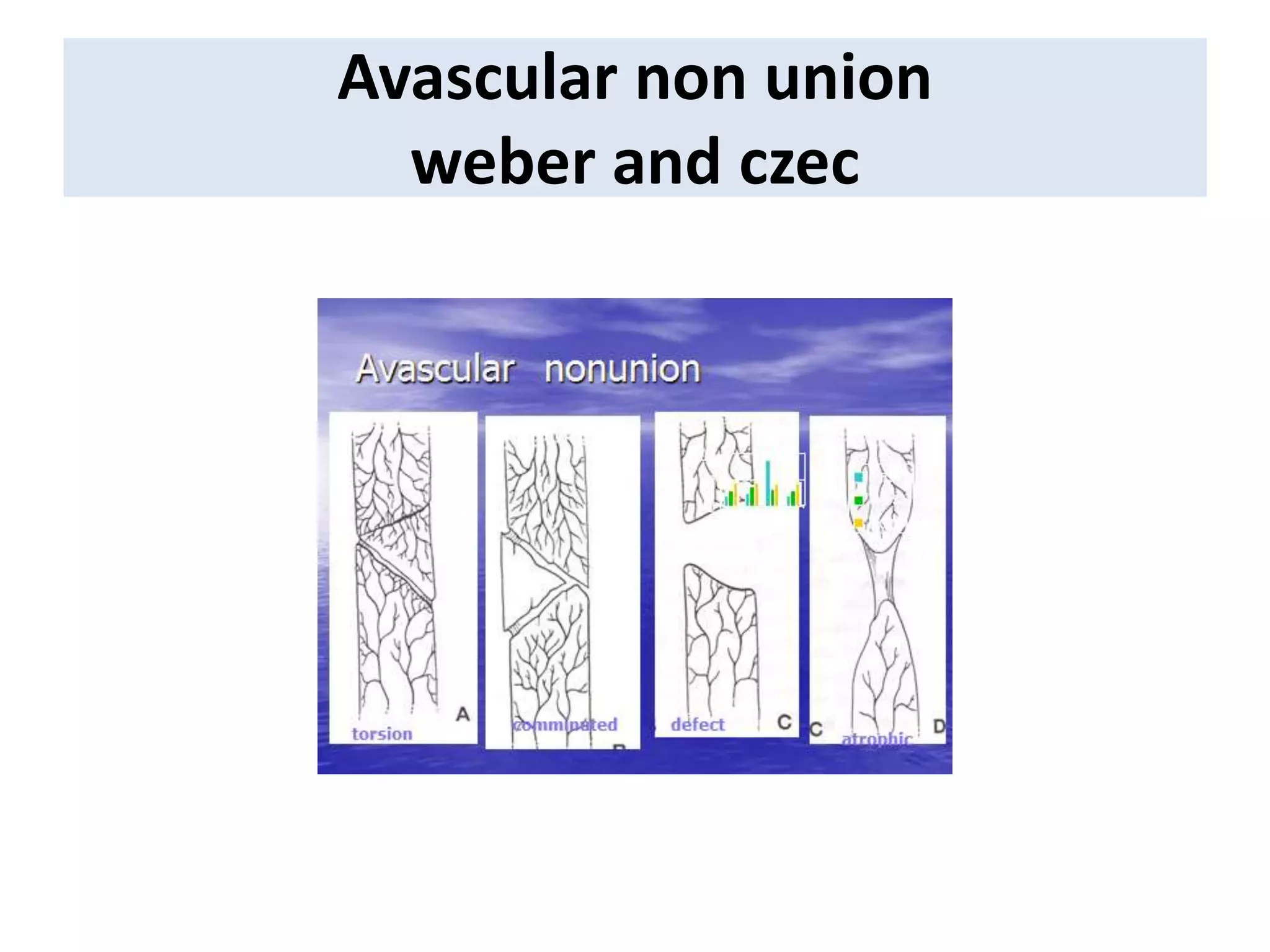 Non union of fractures dr mohamed ashraf,HOD orthopaedics,govt TD ...