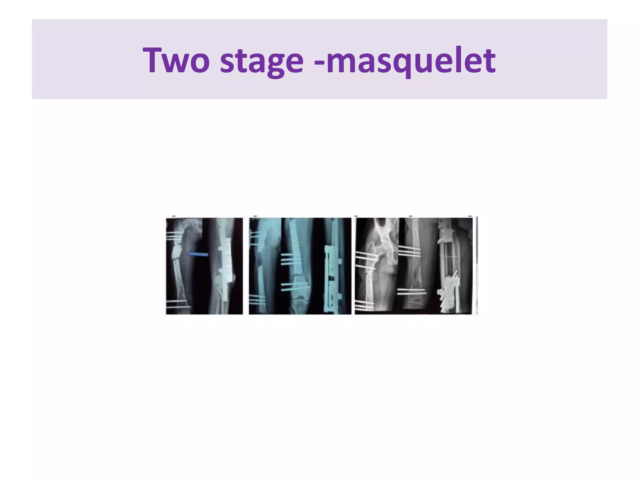Non union of fractures dr mohamed ashraf,HOD orthopaedics,govt TD ...