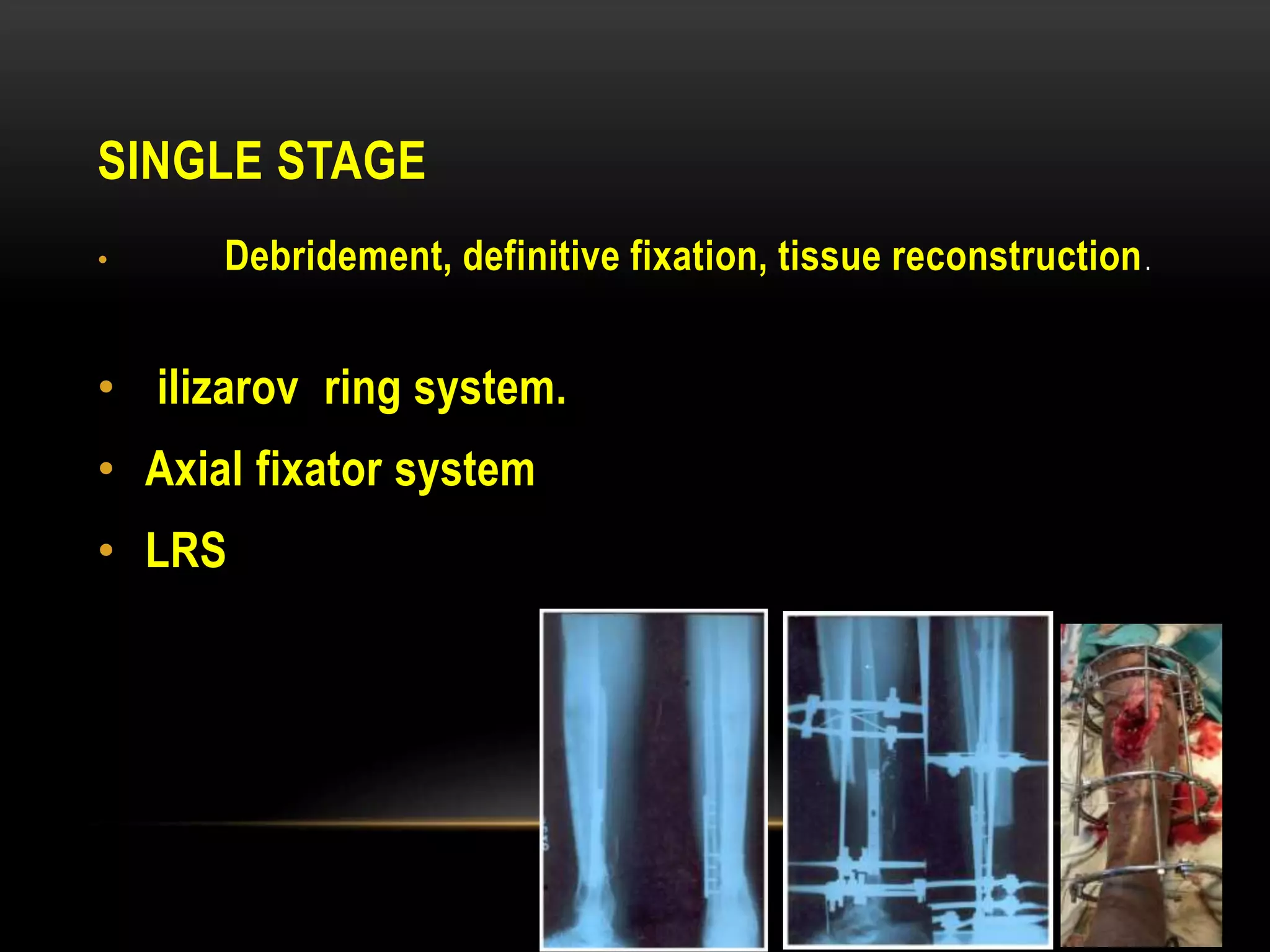 Non union of fractures dr mohamed ashraf,HOD orthopaedics,govt TD ...