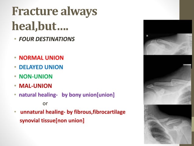 Non union of fractures dr mohamed ashraf,HOD orthopaedics,govt TD ...