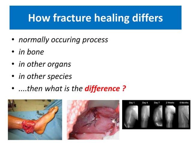 Non union of fractures dr mohamed ashraf,HOD orthopaedics,govt TD ...
