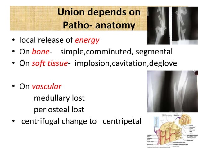 Non union of fractures dr mohamed ashraf,HOD orthopaedics,govt TD ...