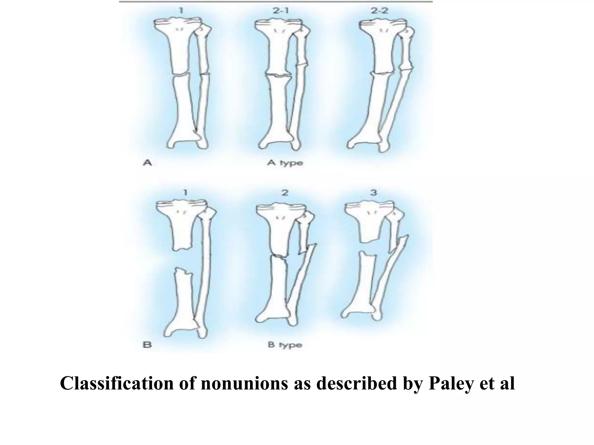 Nonunion definition, causes, classification and management | PPTX