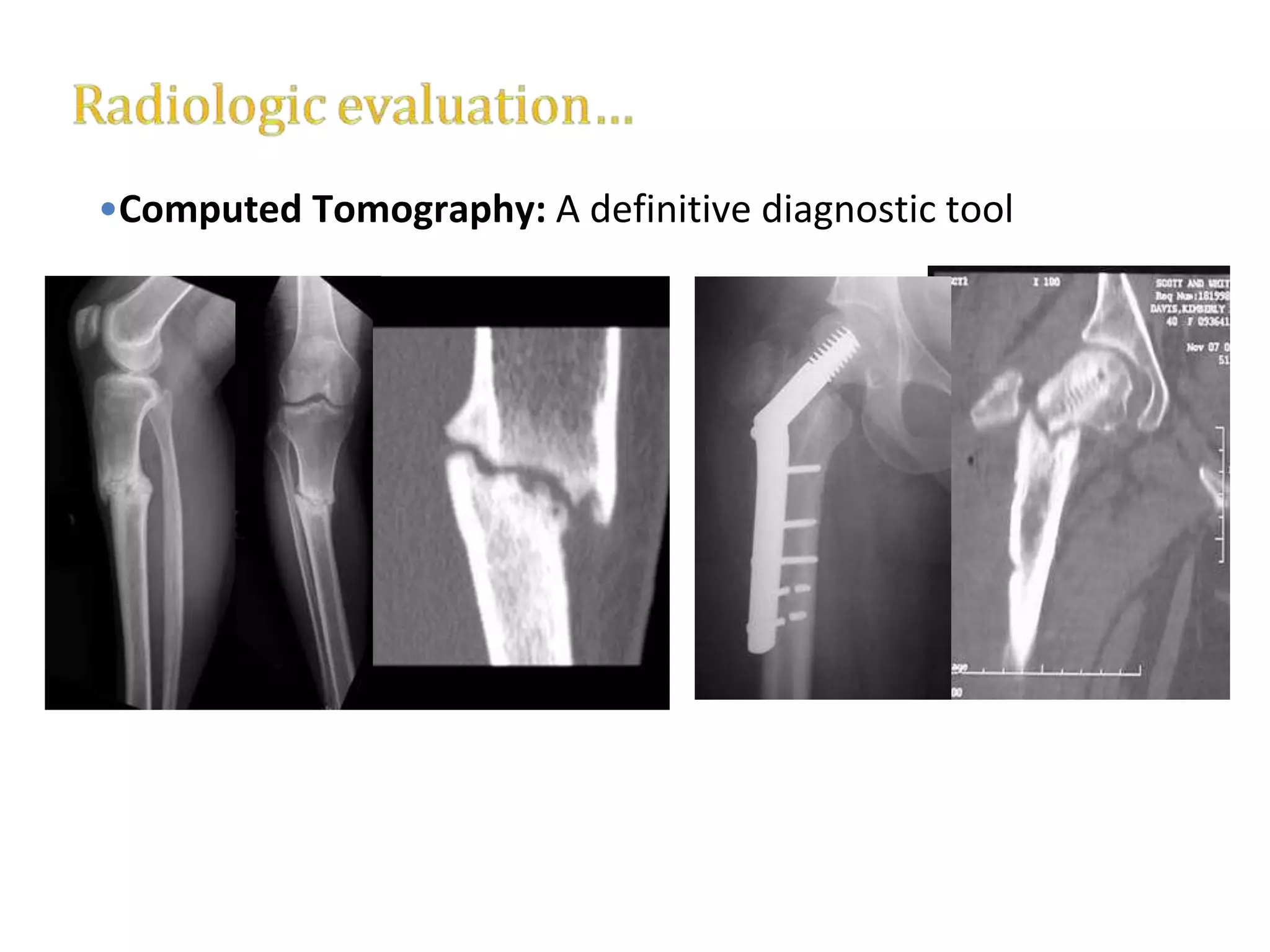 Nonunion definition, causes, classification and management | PPTX