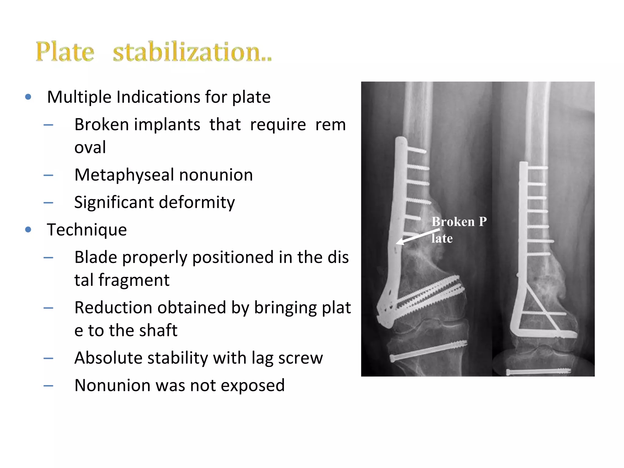 Nonunion definition, causes, classification and management | PPTX