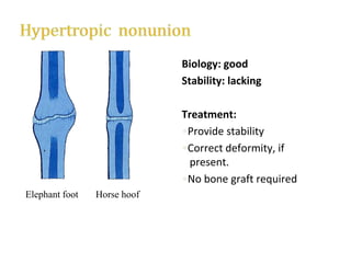 Nonunion definition, causes, classification and management | PPTX