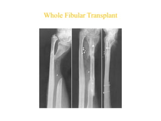 Nonunion definition, causes, classification and management | PPTX