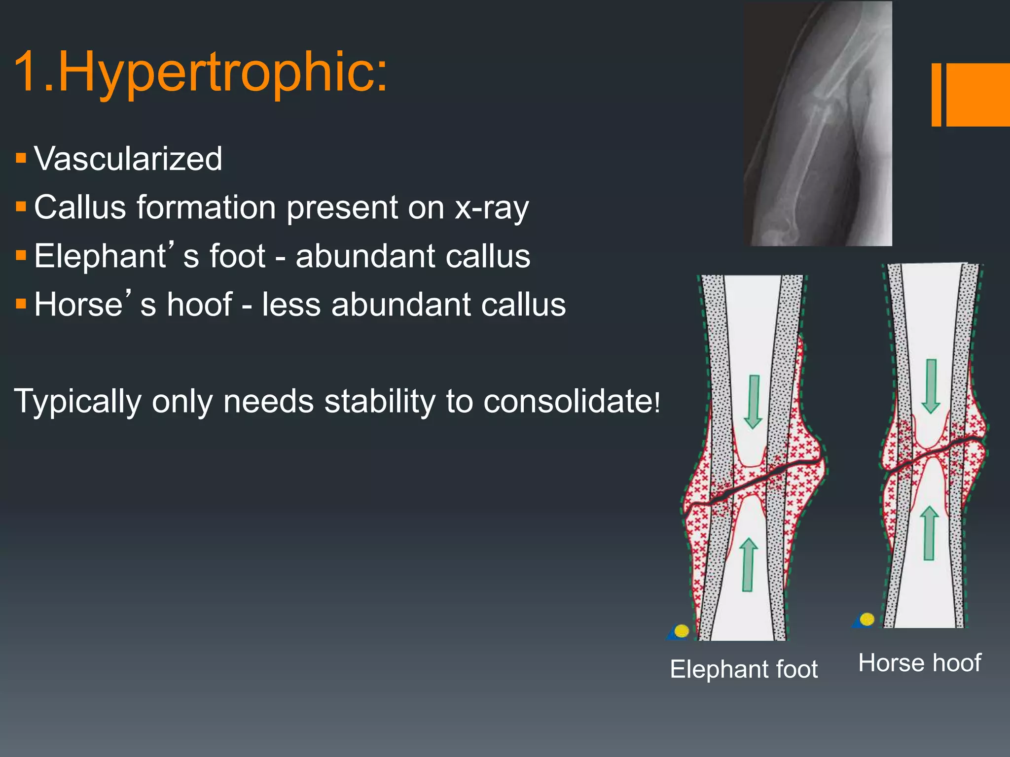 Nonunion ppt | PPTX