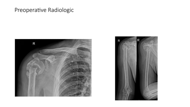 Case Report Non Union Proximal Humerus.pptx