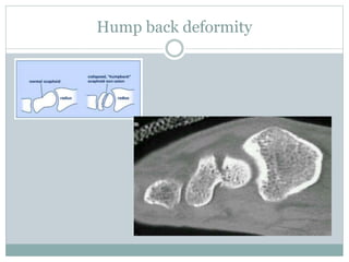 Non union scaphoid 1 | PPTX