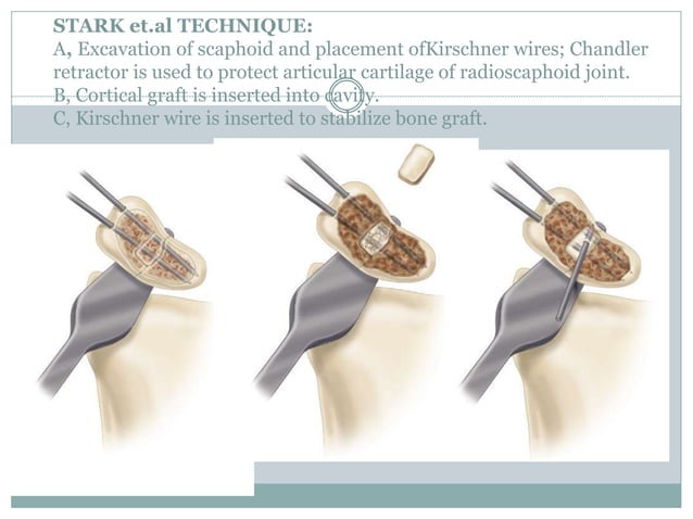 Non union scaphoid 1 | PPTX