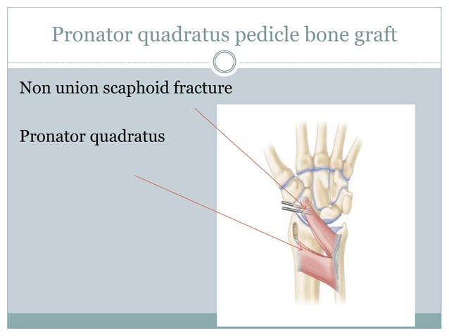 Non union scaphoid 1 | PPTX