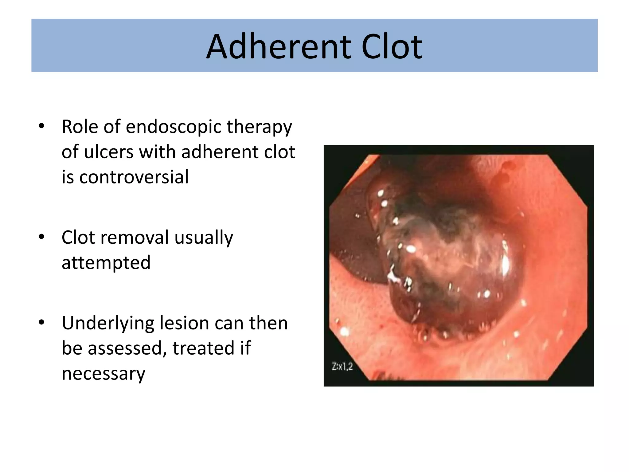 Practical approach to Non variceal bleed | PPTX