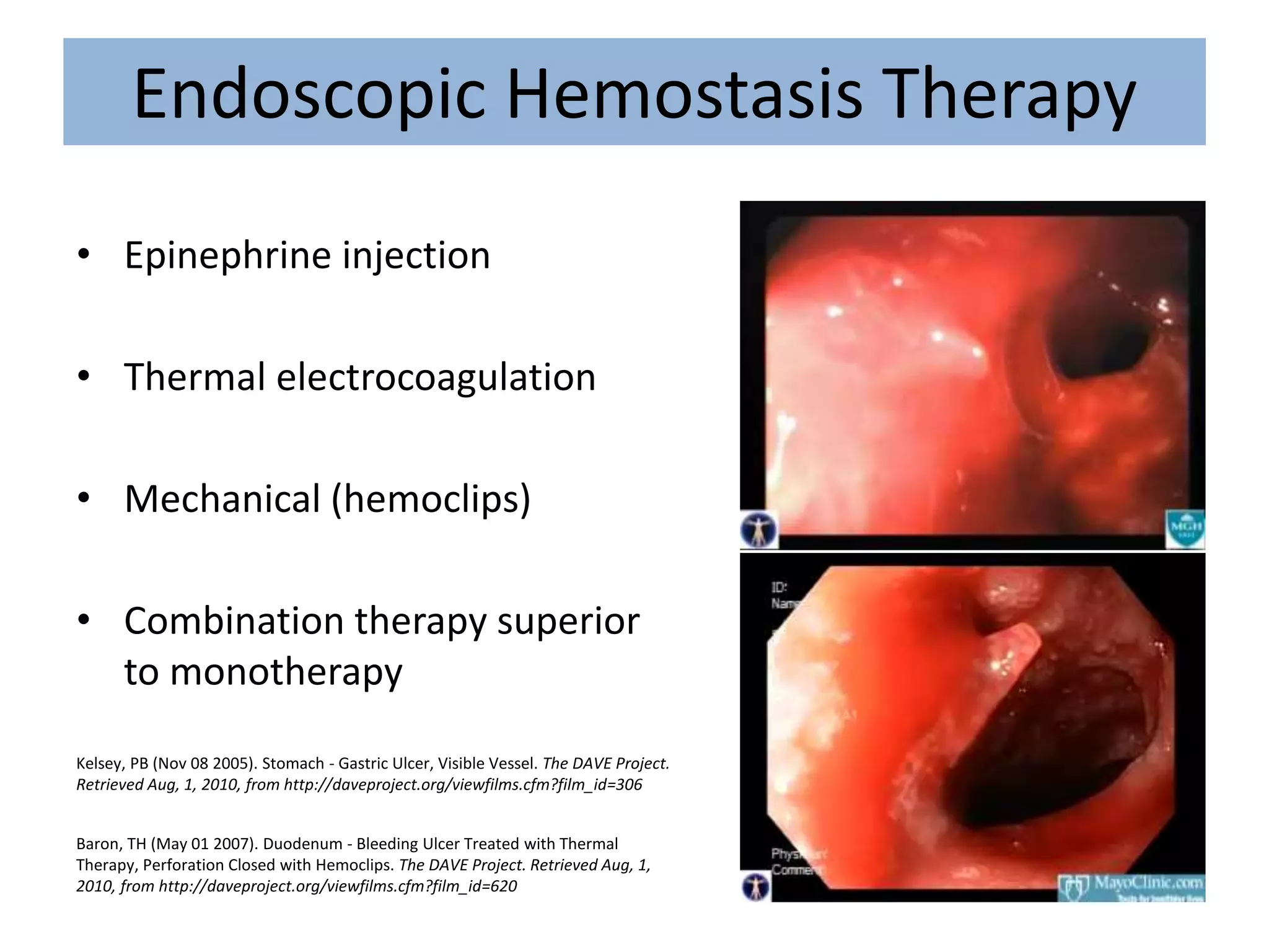 Practical approach to Non variceal bleed | PPTX