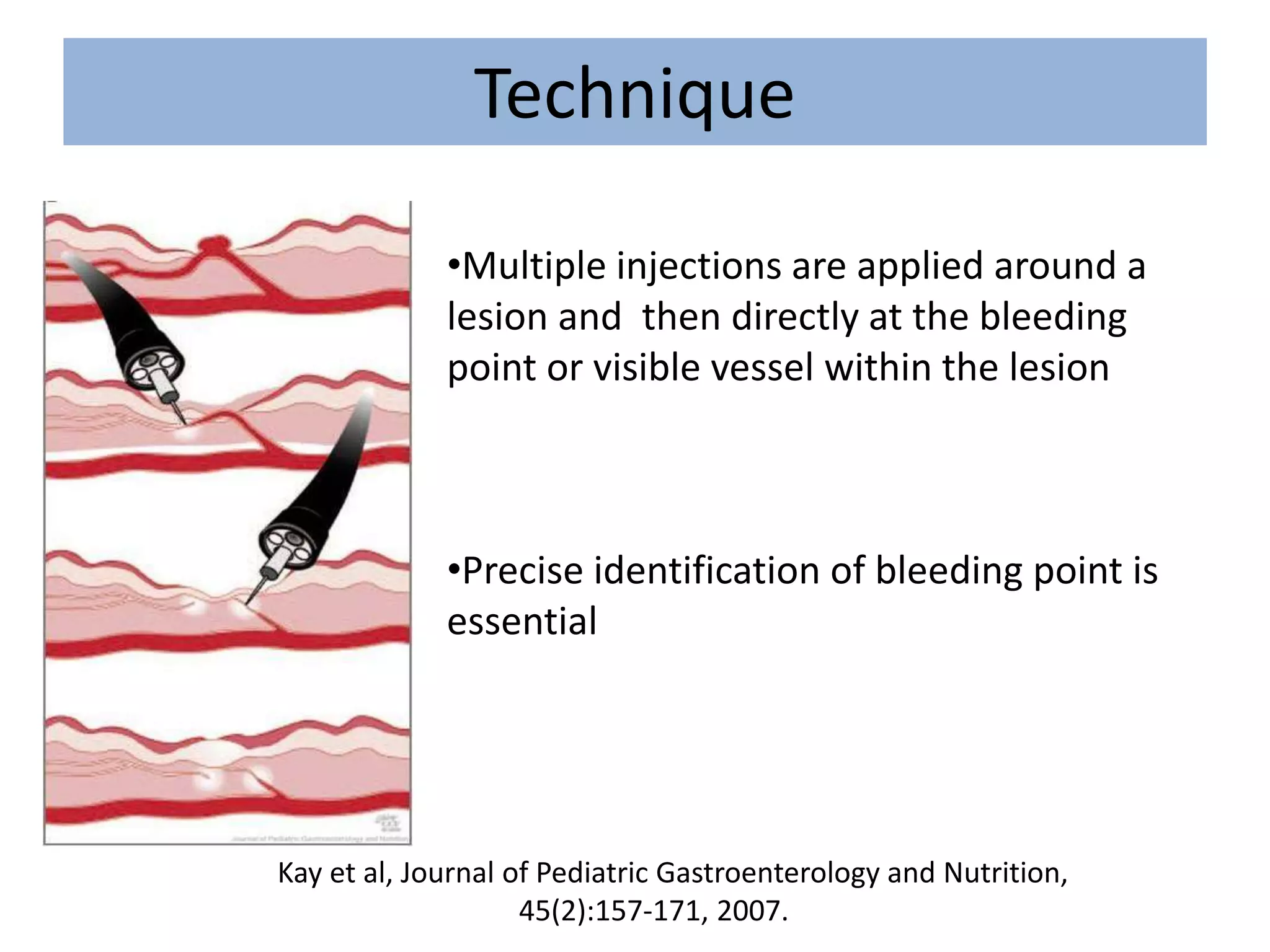Practical approach to Non variceal bleed | PPTX