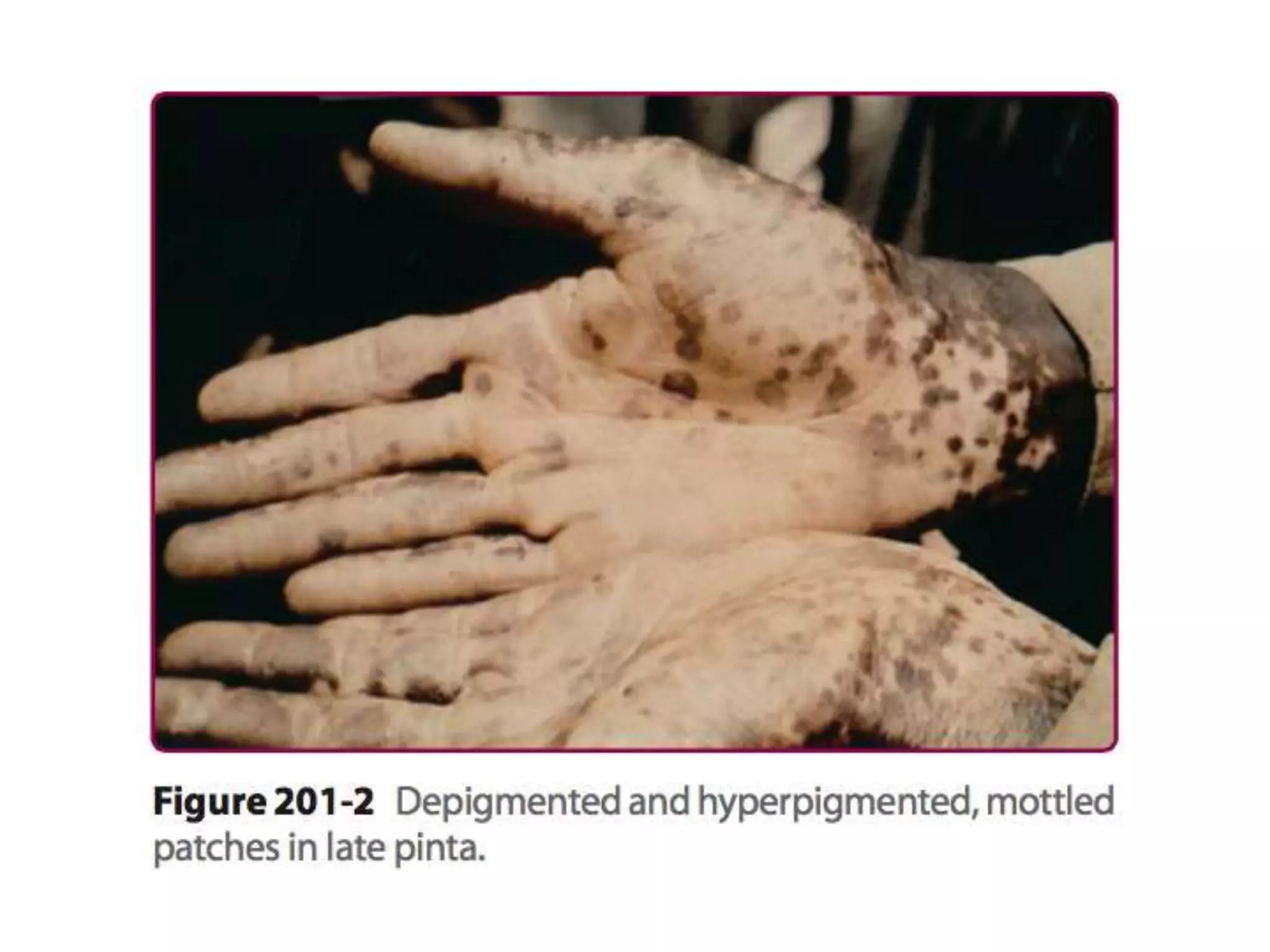 Non Venereal Treponematosis | PPTX