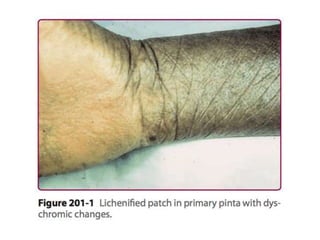 Non Venereal Treponematosis | PPTX