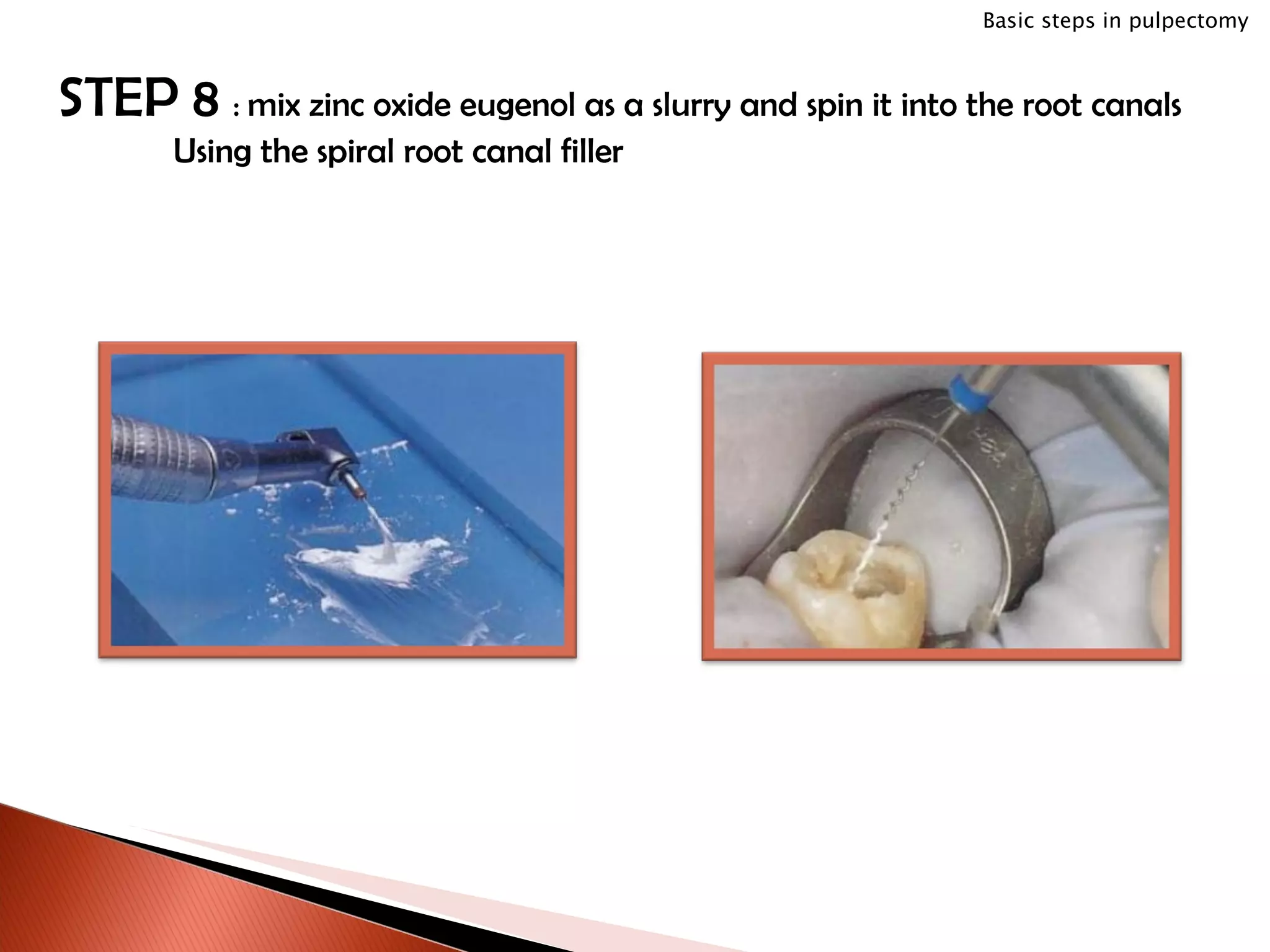 Nonvital pulp therapy in pediatric dentistry | PPT
