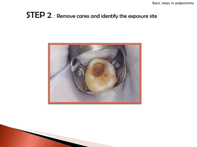 Nonvital pulp therapy in pediatric dentistry | PPT | Dental Health ...
