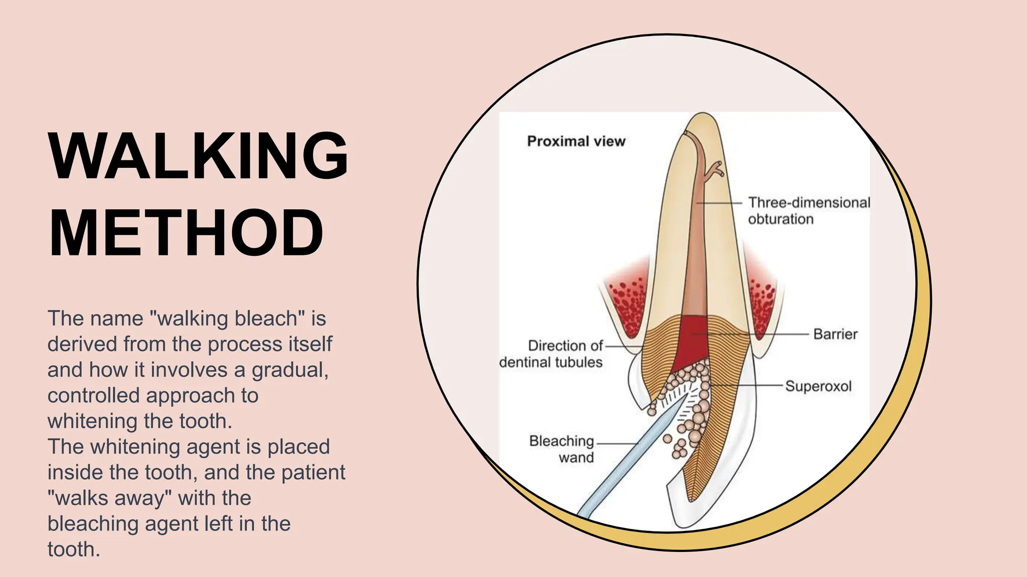 Non Vital Tooth Bleaching .pptx- conservative and endodontics | PPTX