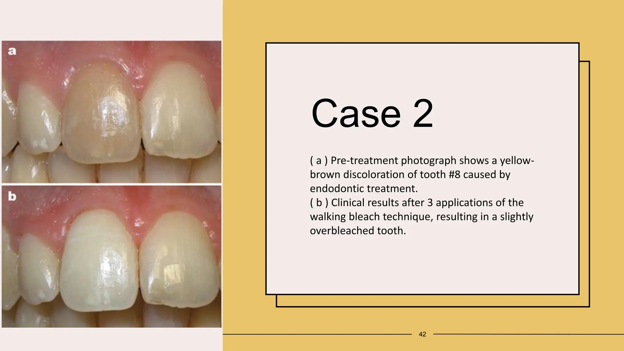 Non Vital Tooth Bleaching .pptx- conservative and endodontics | PPTX