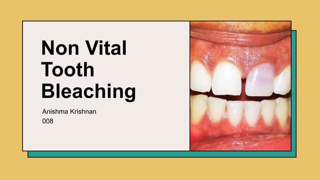 Non Vital Tooth Bleaching .pptx- conservative and endodontics | PPTX ...