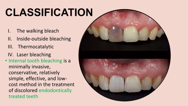 Non Vital Tooth Bleaching .pptx- conservative and endodontics | PPTX ...