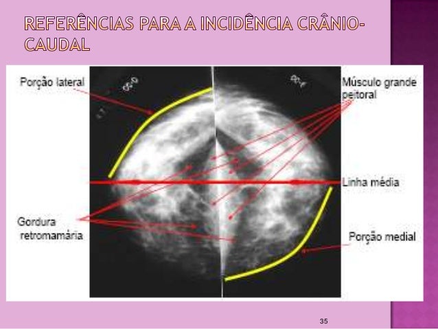 Noçoes de mamografia