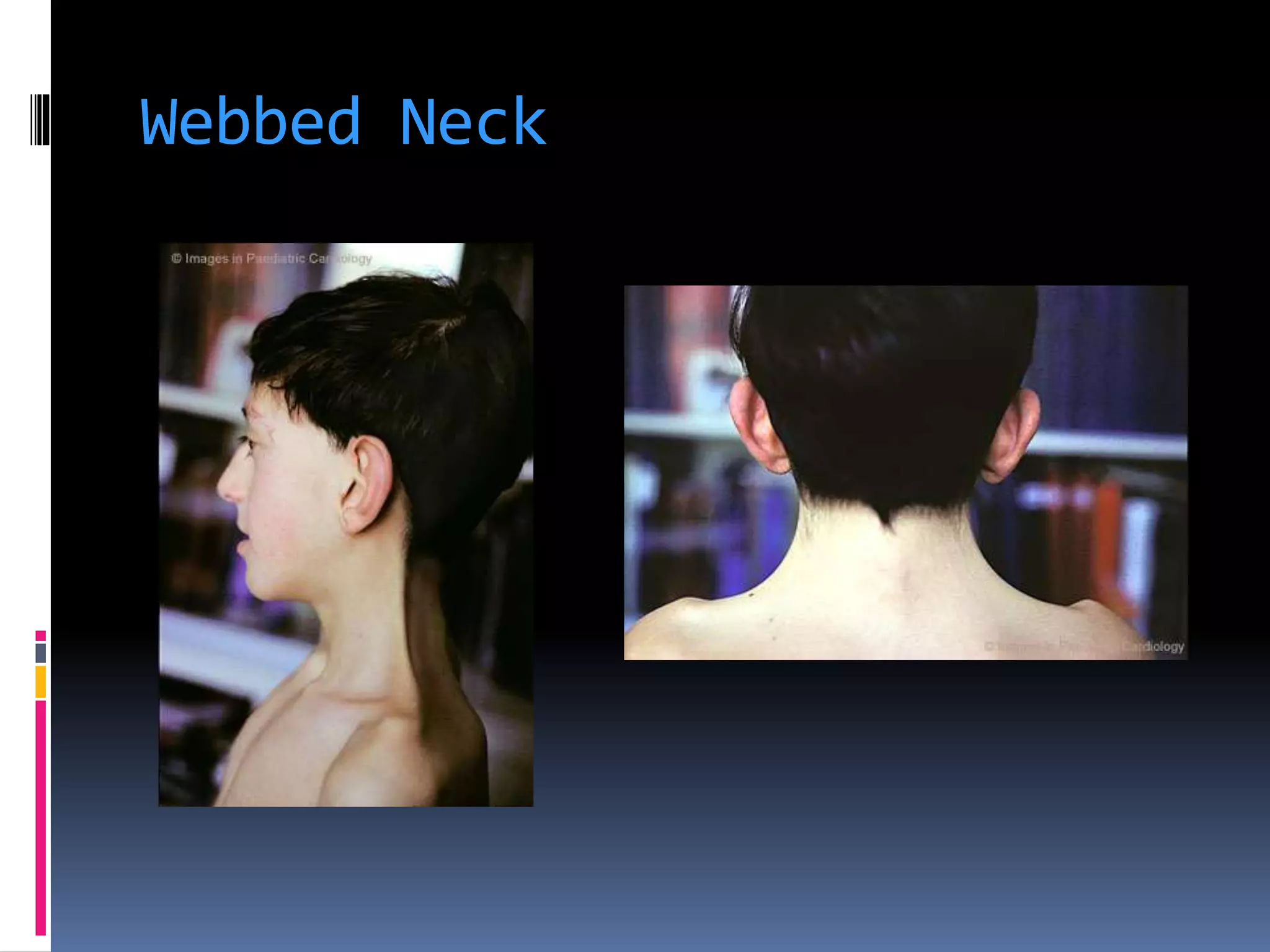 Noonan syndrome | PPTX