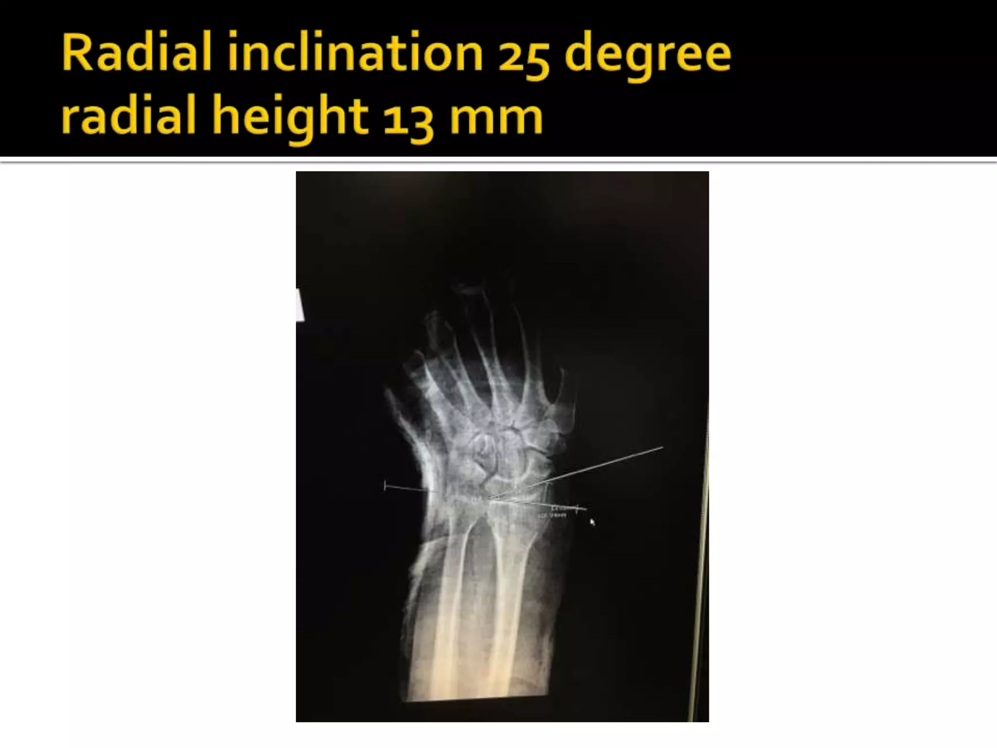 distal end radius fracture | PPTX