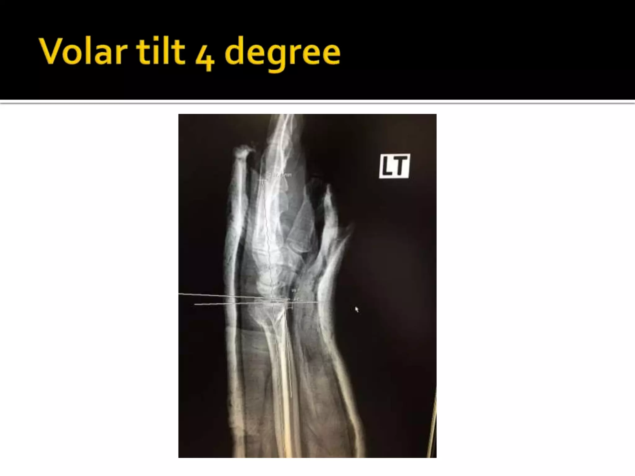 distal end radius fracture | PPTX