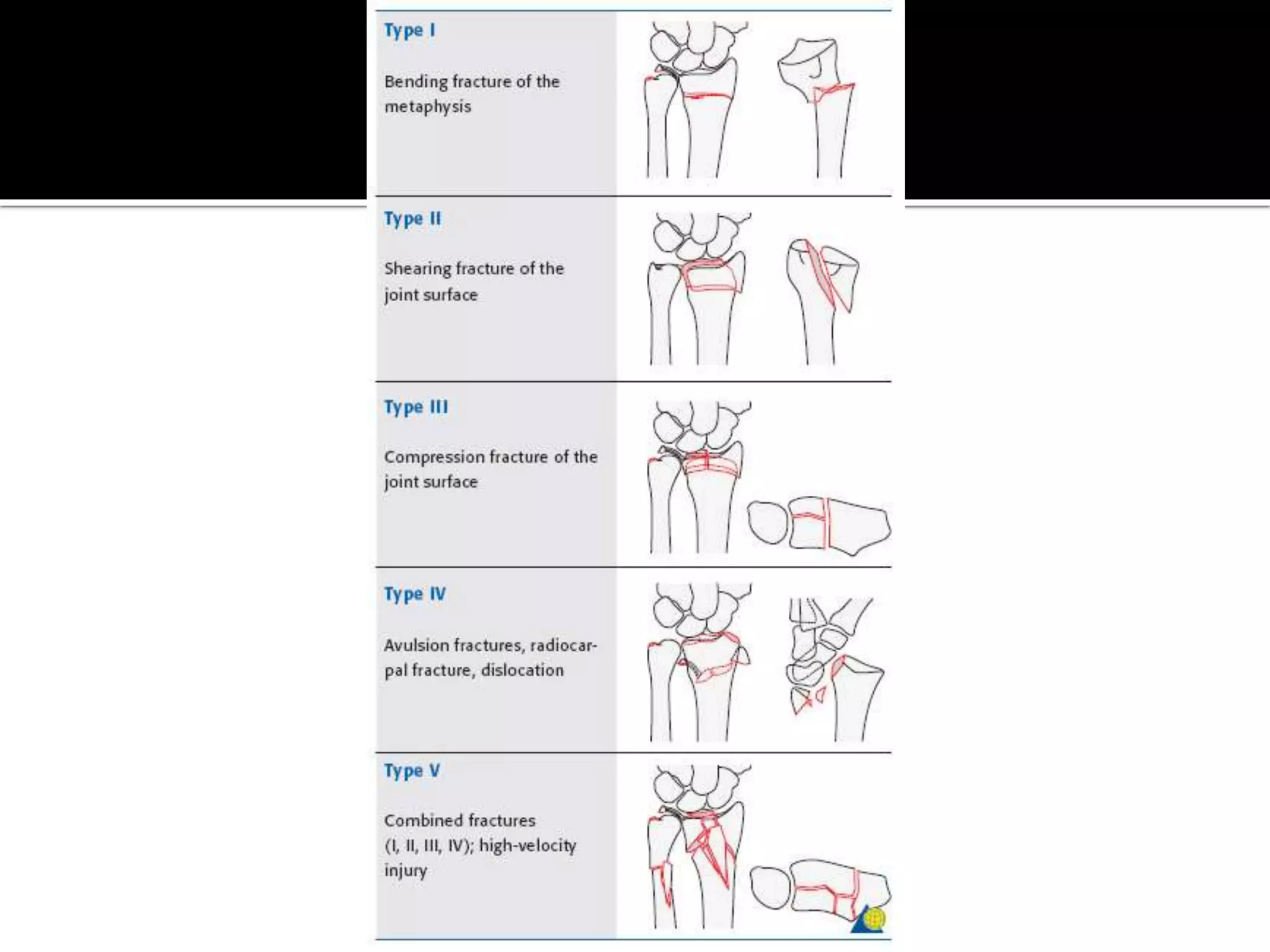distal end radius fracture | PPTX