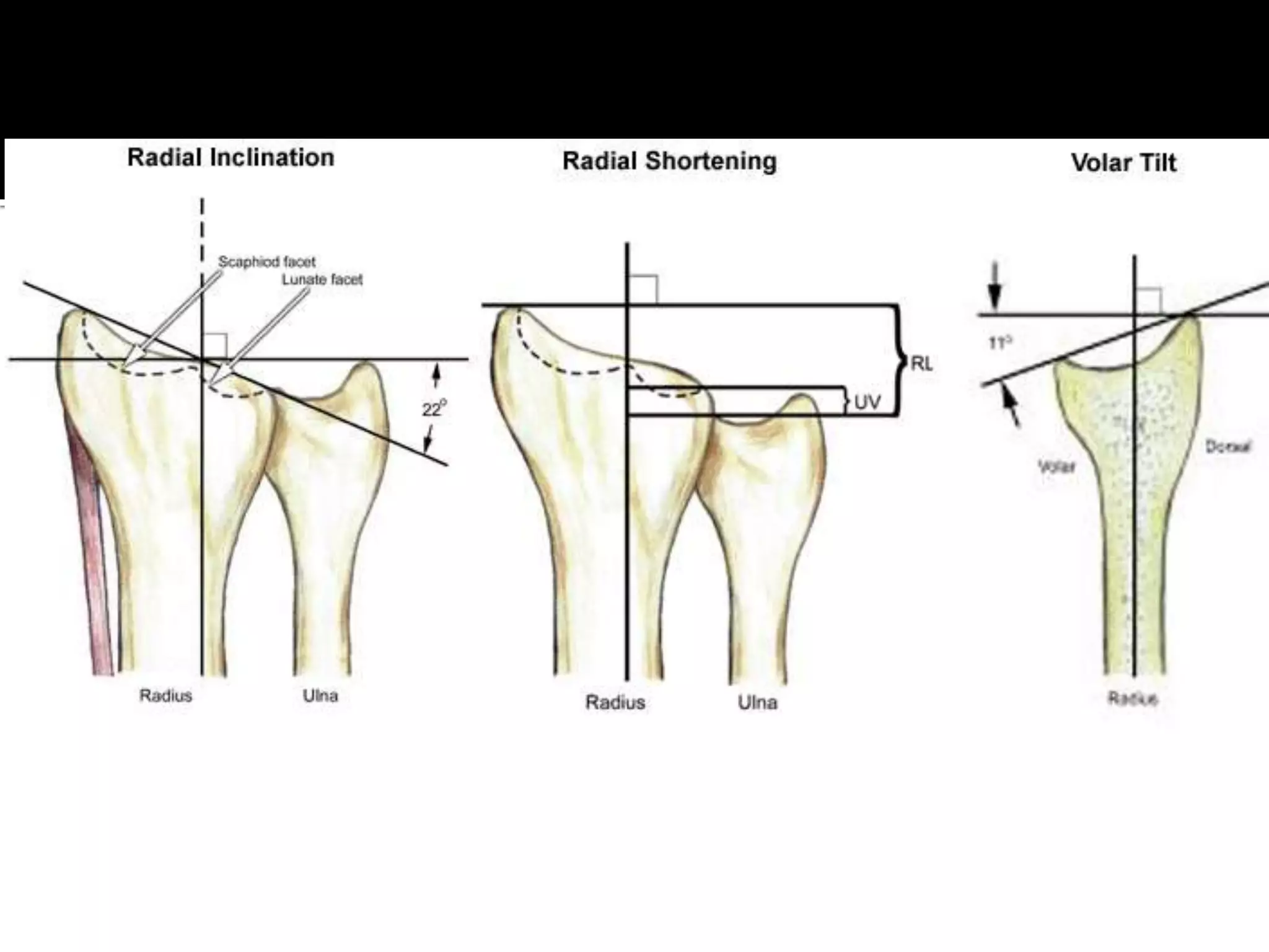 distal end radius fracture | PPTX
